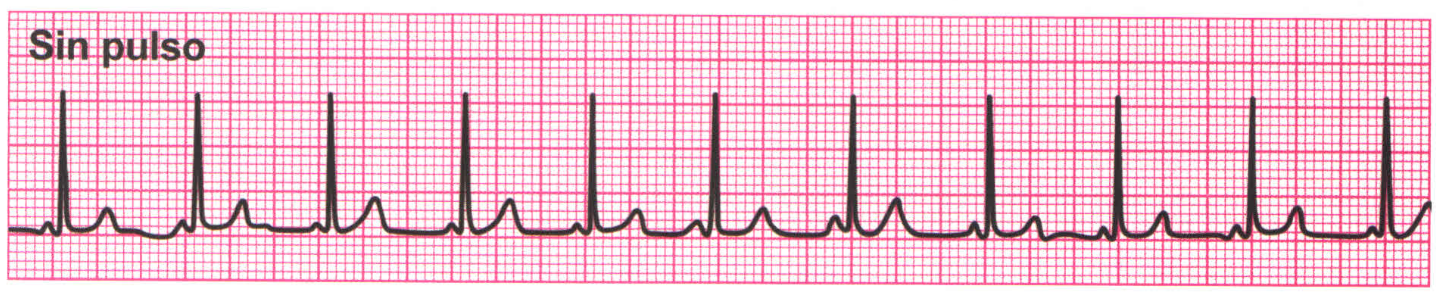 Pea Actividad Eléctrica Sin Pulso Cptc Healthpoint